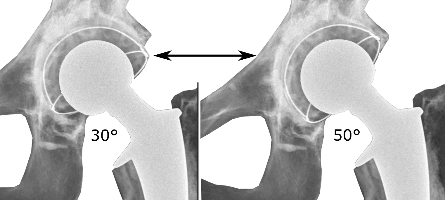 Classification Of Acetabular Defects In Revison Total Hip